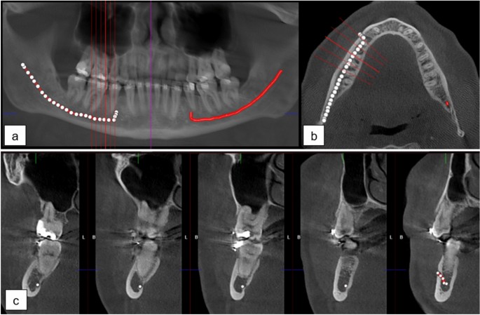 The Role of AI in Tracing the Inferior Dental Nerve (IDN) on Dental ...