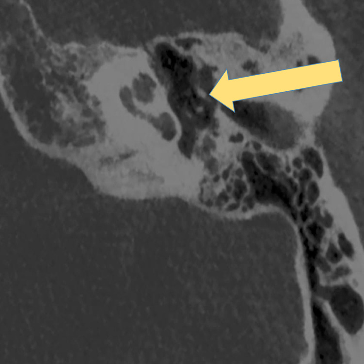 CBCT for Temporal Bones - The New Gold Standard - Cavendish Imaging