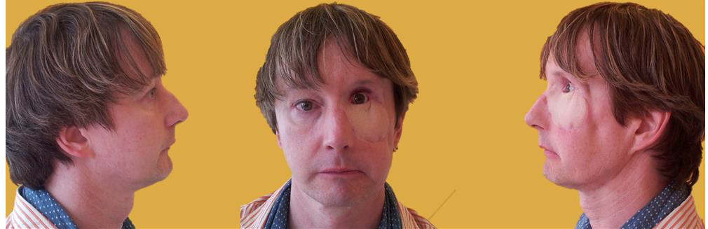 3D Printed Model for Jaw Reconstruction Surgery in Caner Patient