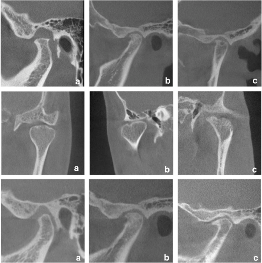 Advantages of CBCT in TMJ Assessment - Cavendish Imaging