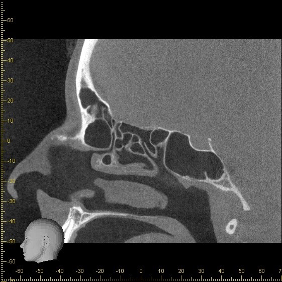 ENT [Ears Nose Throat] Studies – Titanium Dental Imaging [TDIX]